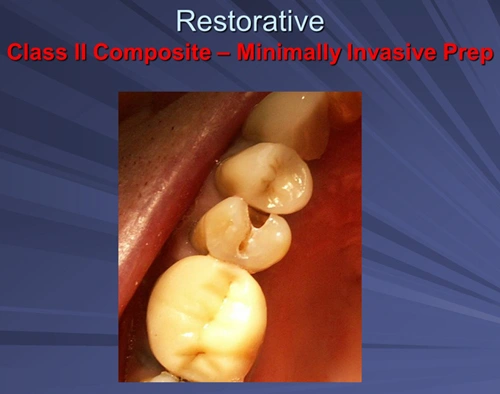 Restorative Dentistry | Lasers in Dentistry: Minimally Invasive ...