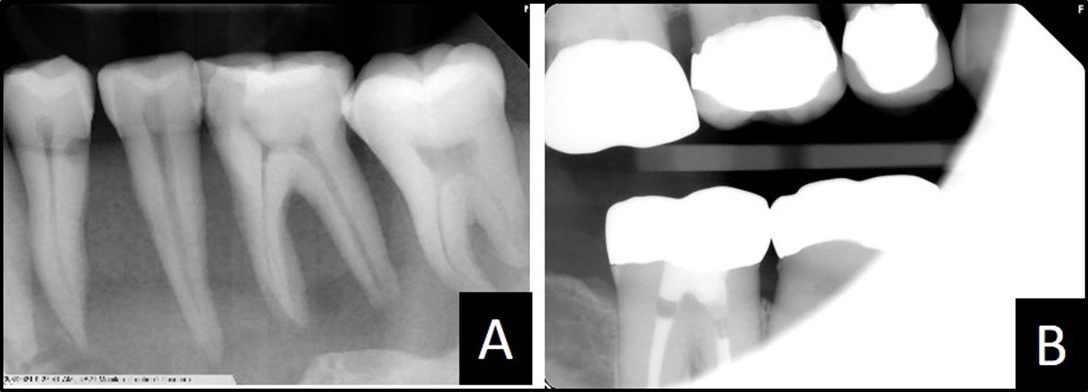 The Path of Radiation | Intraoral Imaging Techniques: Beyond the ...