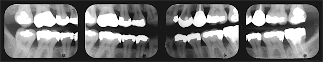 Bitewing Surveys - Intraoral Radiographic Anatomy - Dentalcare