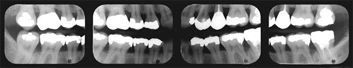 Bitewing Surveys - Intraoral Radiographic Anatomy - Dentalcare