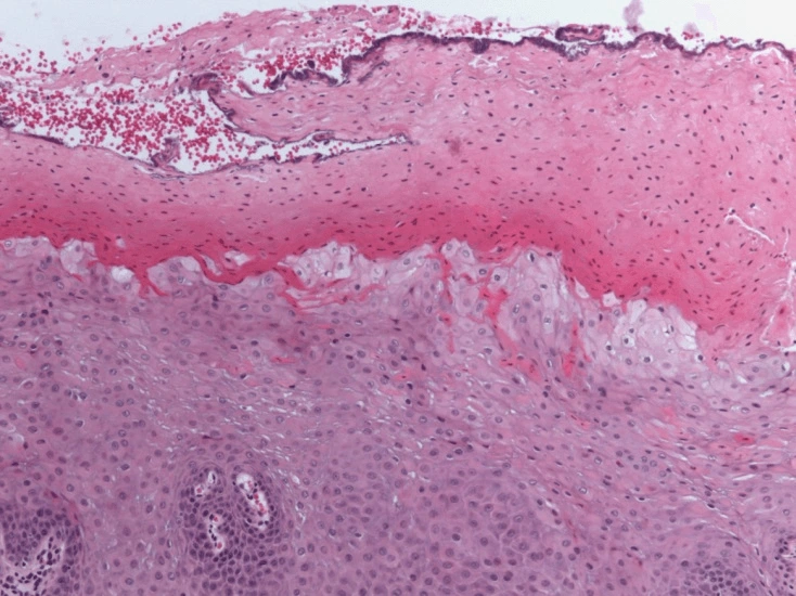 Diagnostic Information | White Plaques on the Cheeks | dentalcare.com