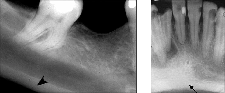 Mandibular Posterior Landmarks - Intraoral Radiographic Anatomy ...