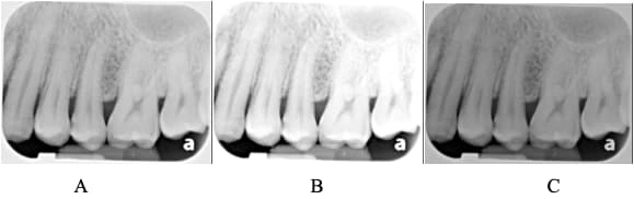 Radiographic Density - The Radiographic Image - Dentalcare