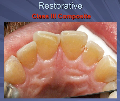 Restorative Dentistry | Lasers in Dentistry: Minimally Invasive ...