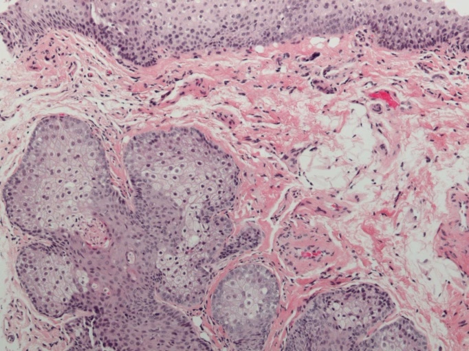 Diagnostic Information | Incidental Yellow Papules in the Upper Lip ...