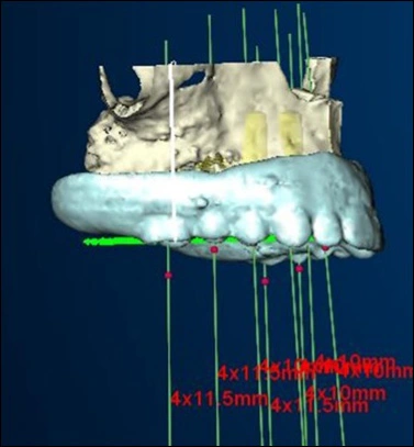 Diagnosis and Treatment Planning for Implant Prostheses - Full Arch ...