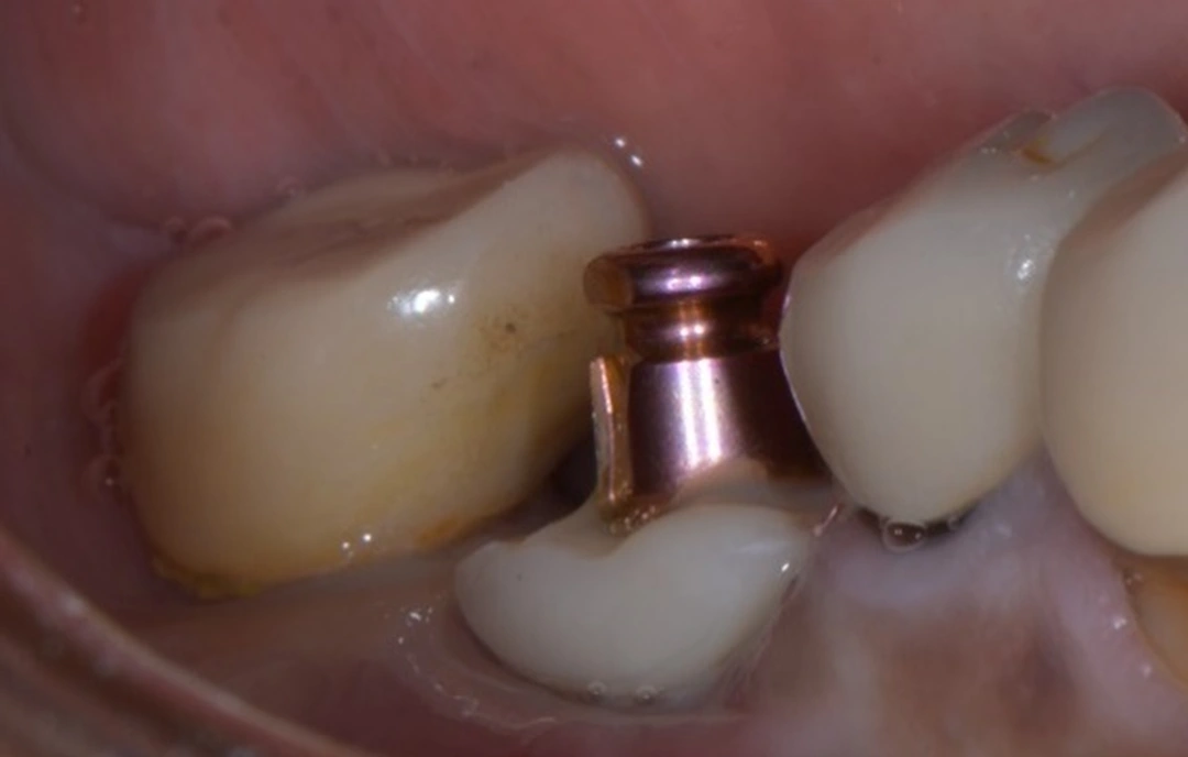 Placement of a Well-contoured Provisional Restoration/Custom Healing ...