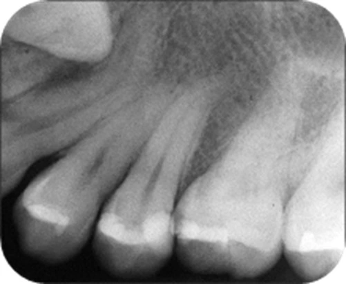 Dilaceration - Anomalies of the Tooth - CE651