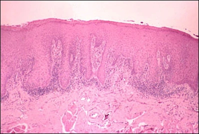 Diagnostic Information | White Plaque of the Lateral Tongue ...
