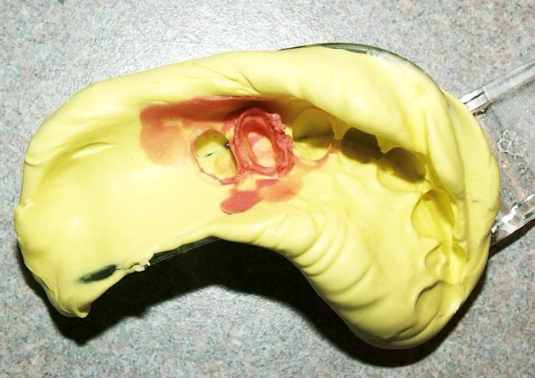 Minimal Flap Crown Lengthening | Lasers in Dentistry: Minimally ...