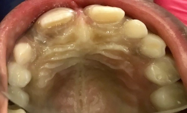 Local Infiltration of the Palate - Local Anesthesia in Pediatric ...