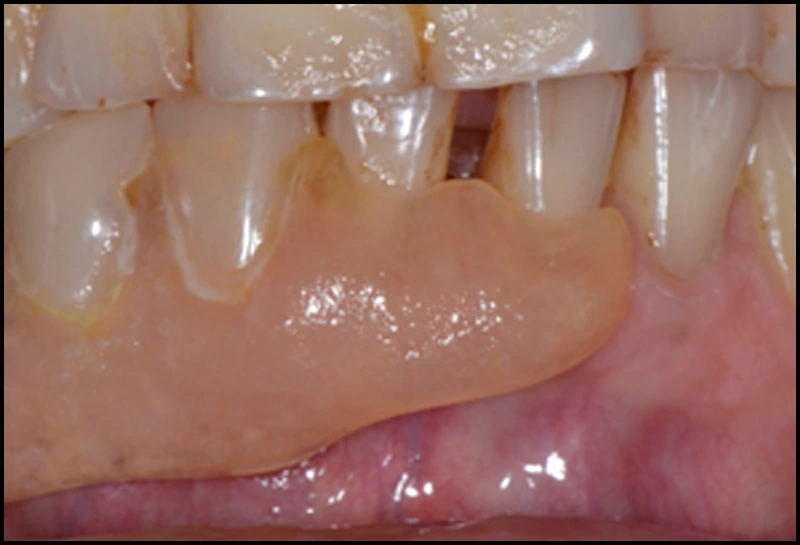 Indications for Non-metal clasp dentures (NMCD) | Non-Metal Clasp ...