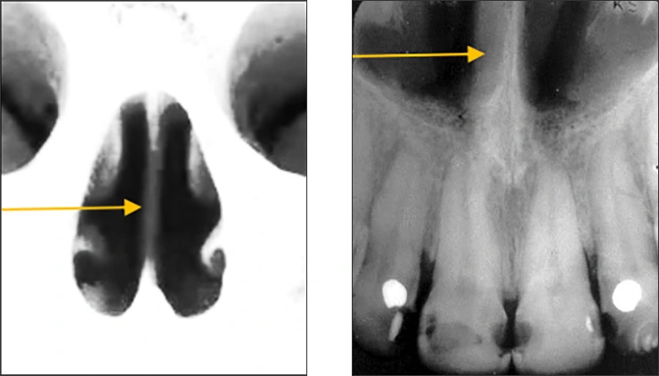 Maxillary Anterior Landmarks - Intraoral Radiographic Anatomy - Dentalcare