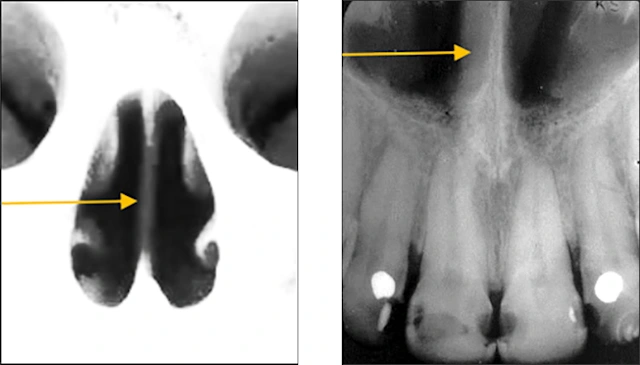 Maxillary Anterior Landmarks - Intraoral Radiographic Anatomy - Dentalcare