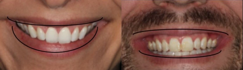 Lip Curvature - Evaluating and Establishing Ideal Smile Esthetics ...
