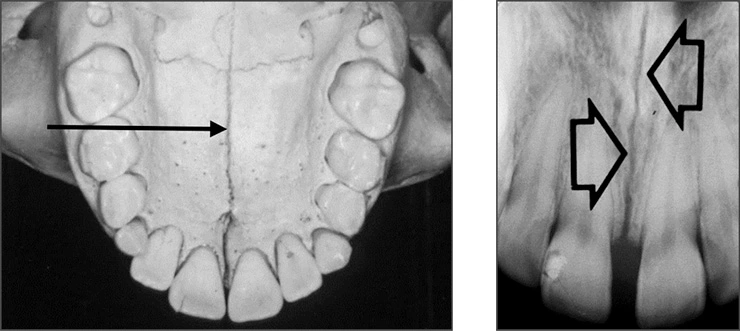 Maxillary Anterior Landmarks - Intraoral Radiographic Anatomy - Dentalcare