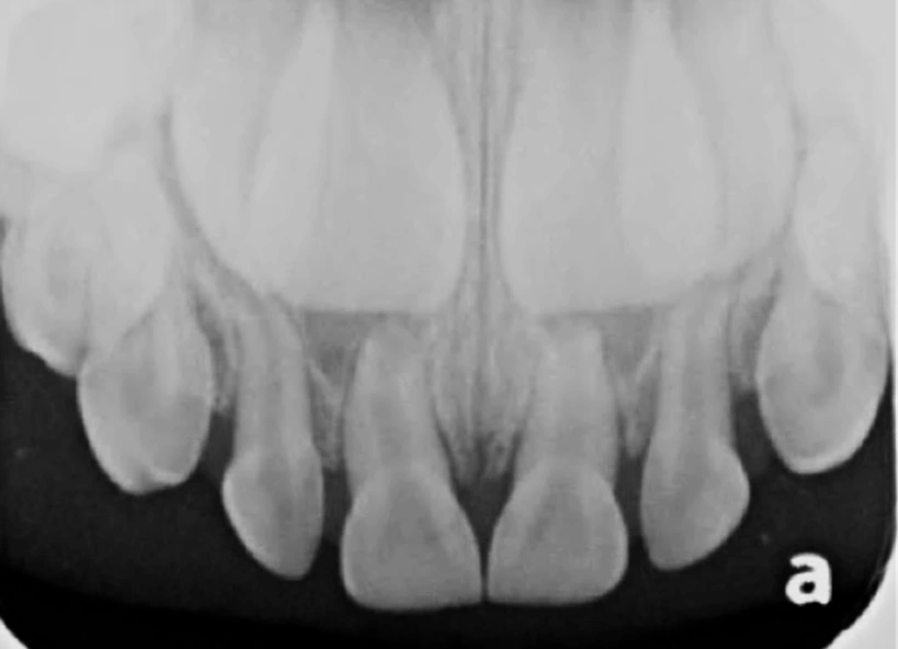Periapical/Occlusal Radiographs - Radiographic Techniques for the ...