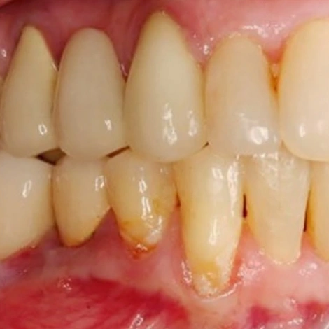 The 2018 AAP/EFP Classification of Periodontal & Peri-implant Diseases ...
