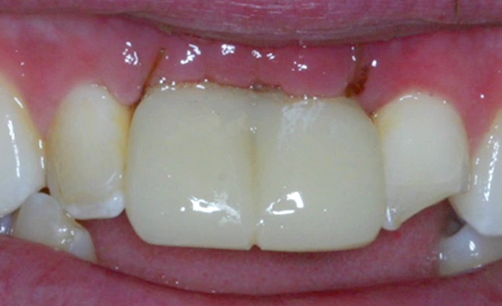 Placement of a Well-contoured Provisional Restoration/Custom Healing ...