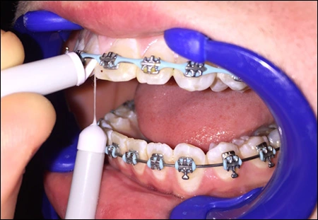Flossing - Ortho 101 for the Dental Professional - Dentalcare
