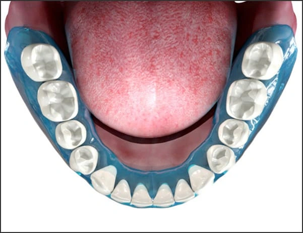 Appropriate Application of Denture Adhesive | Prosthesis Retention and ...