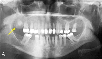 Diagnostic Information | A Mass of the Maxillary Tuberosity ...