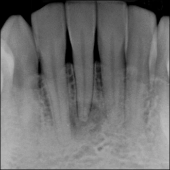 Periapical Lesion Involving a Mandibular Incisor Tooth | Introduction ...