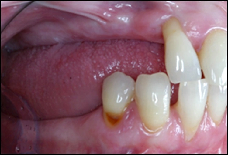 Contraindications for Non-metal clasp dentures (NMCD) | Non-Metal Clasp ...