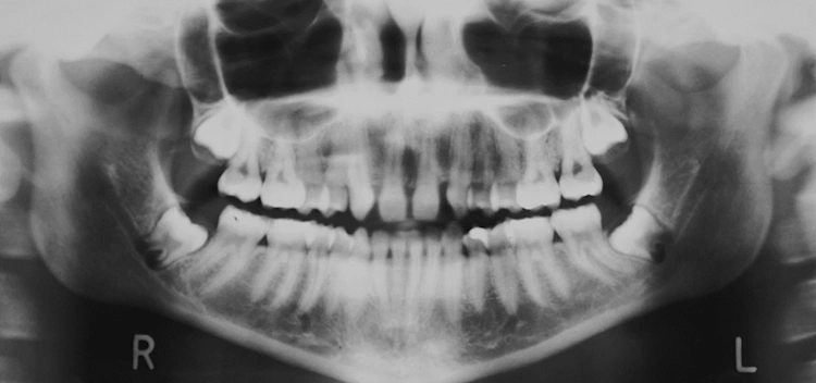Alterations in the Number of Teeth - Anomalies of Tooth Structure ...
