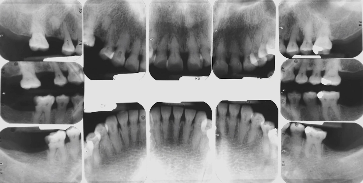 Loss of Tooth Structure - Anomalies of Tooth Structure - Dentalcare