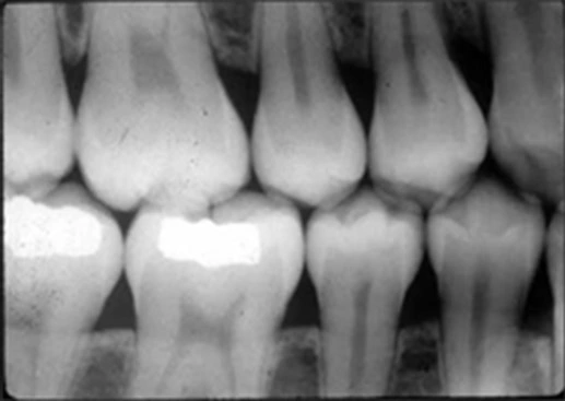Normal Radiographic Appearance of the Supporting Structures of the ...