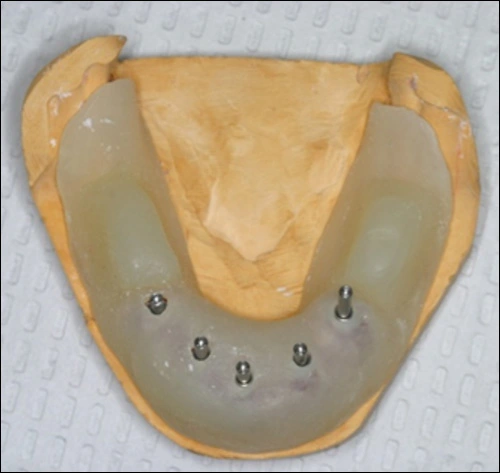 Second Clinical Appointment - Full Arch Implant Prostheses: Part II ...