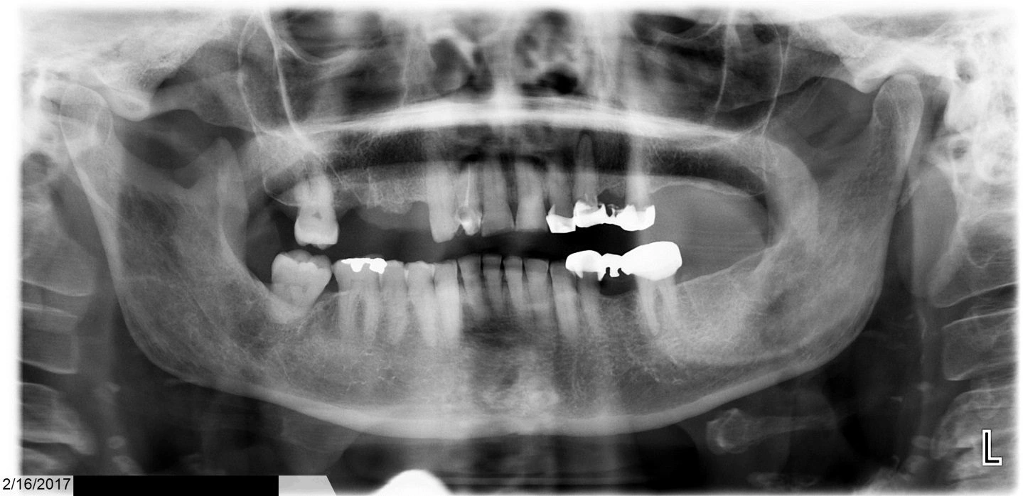 Diagnostic Information | Asymptomatic Alveolar Swelling After a Tooth ...