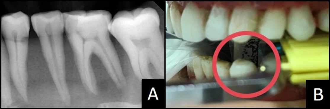 Horizontal Angulation: How do I know that the distal canine crown will ...