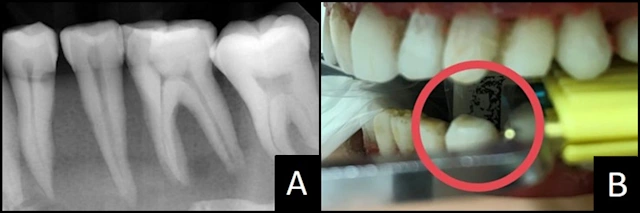 Horizontal Angulation: How do I know that the distal canine crown will ...