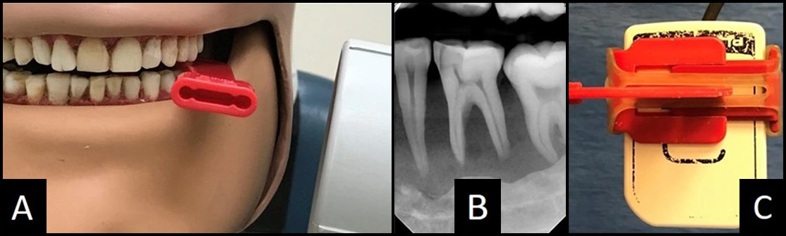 Problem #2: Difficulty Positioning Sensor for Mandibular Molar ...