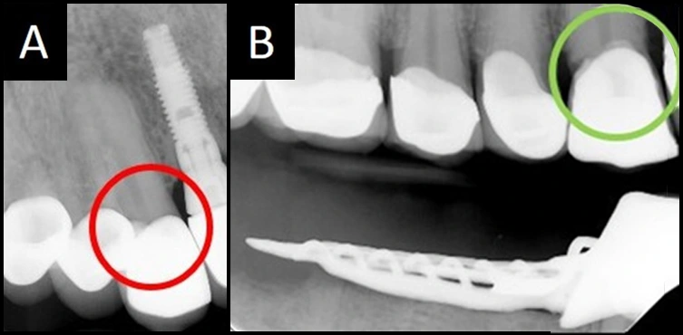 Problem #9: Capturing the Mesial and Distal of a Canine | Intraoral ...