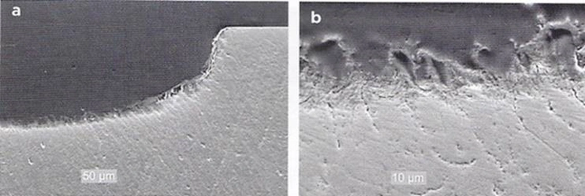 Dental Erosion | A-Z Fundamentals of Dentifrice | Continuing Education ...