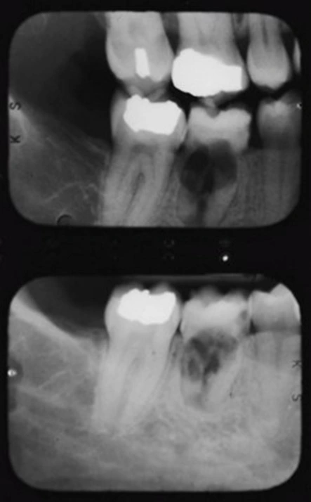 Resorptive Processes - Anomalies of Tooth Structure - Dentalcare