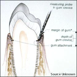 Terms M-Z - Oral Health Care: A Whole New Language - Dentalcare
