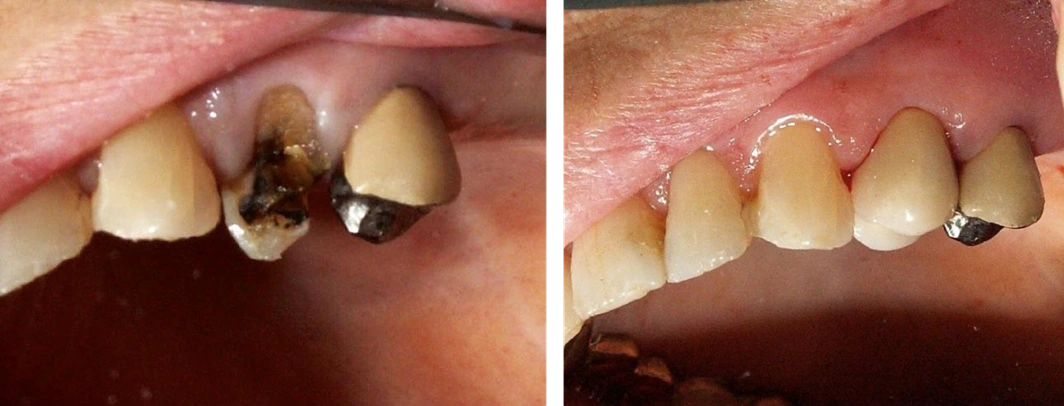 Minimal Flap Crown Lengthening | Lasers in Dentistry: Minimally ...