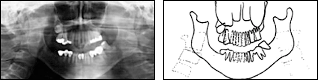Incorrect Head Orientation - Practical Panoramic Imaging - Dentalcare