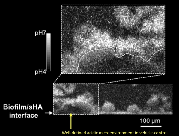 The Caries Process & Fluoride’s Mechanism of Action | A-Z Fundamentals ...