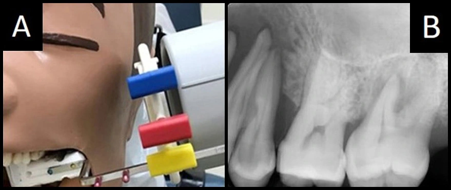 Vertical Angulation Why Are The Incisal Edges Cusp Tips Not Captured ...