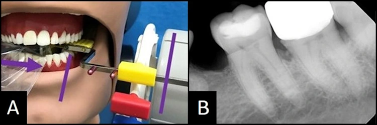 Vertical Angulation: How do I know if I can follow the aiming ring ...