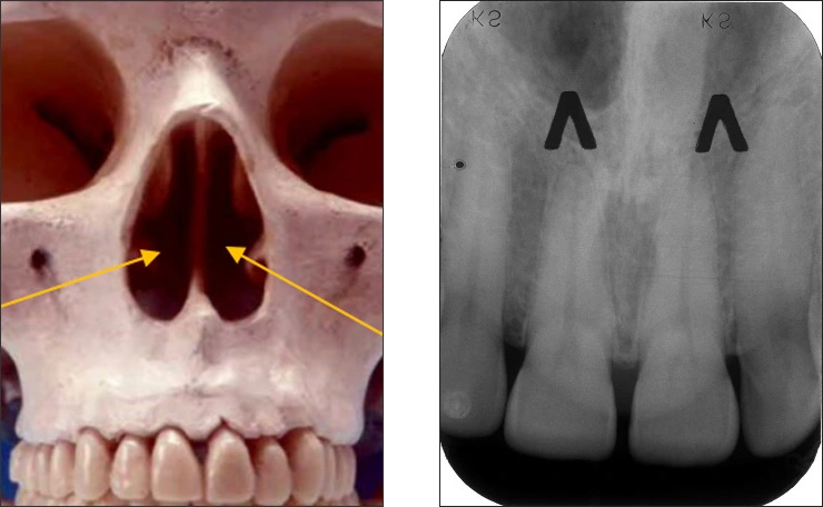 Maxillary Anterior Landmarks - Intraoral Radiographic Anatomy - Dentalcare