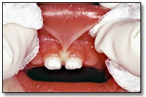 Diastema - Smiles For Tomorrow - Dentalcare