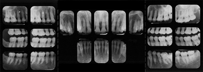 Full Mouth Surveys - Intraoral Radiographic Anatomy - Dentalcare