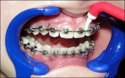 Oral Irrigation - Ortho 101 for the Dental Professional - Dentalcare