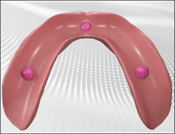 Appropriate Application of Denture Adhesive | Prosthesis Retention and ...